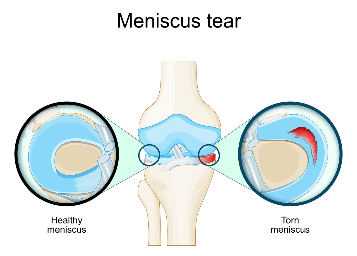 What Causes a Meniscus Tear & How to Treat It | Dr. Howard